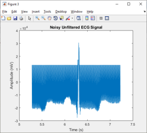 ECG Signal Processing in MATLAB | FYP Solutions